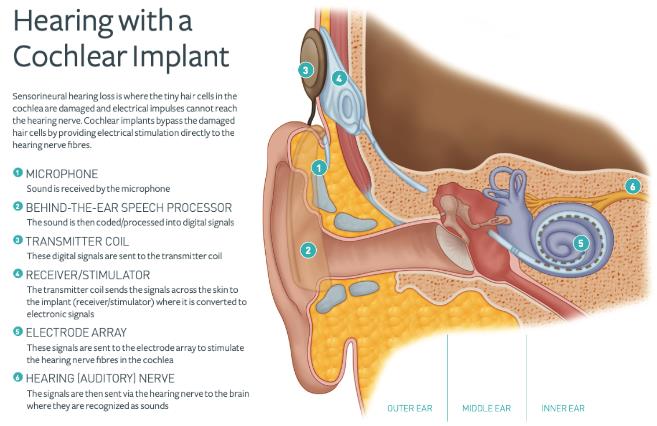 Cochlear Implants - Auditory Implant Service