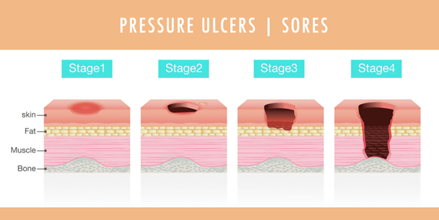 Understanding Pressure Ulcers: A Journey Beneath the Skin ...